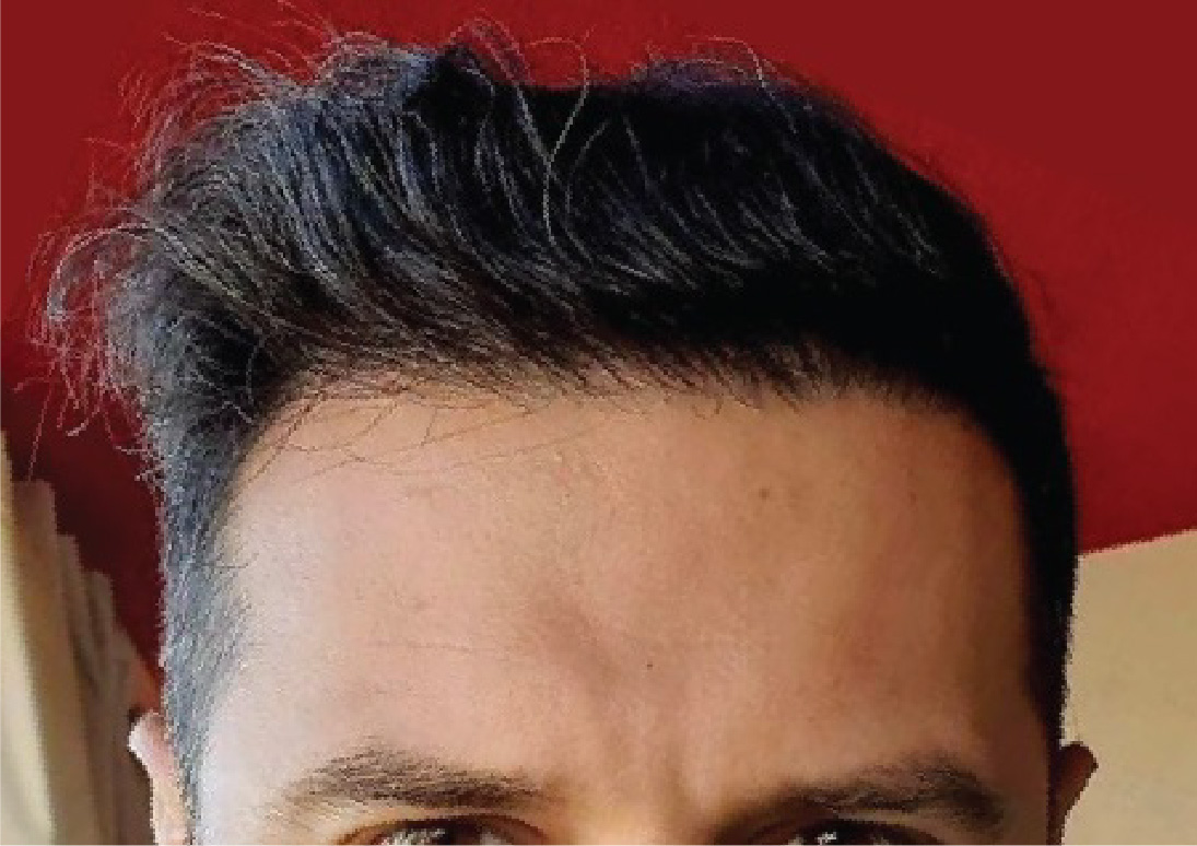 Transplant de Păr Profesional - Arta Hair Clinic Cluj Napoca